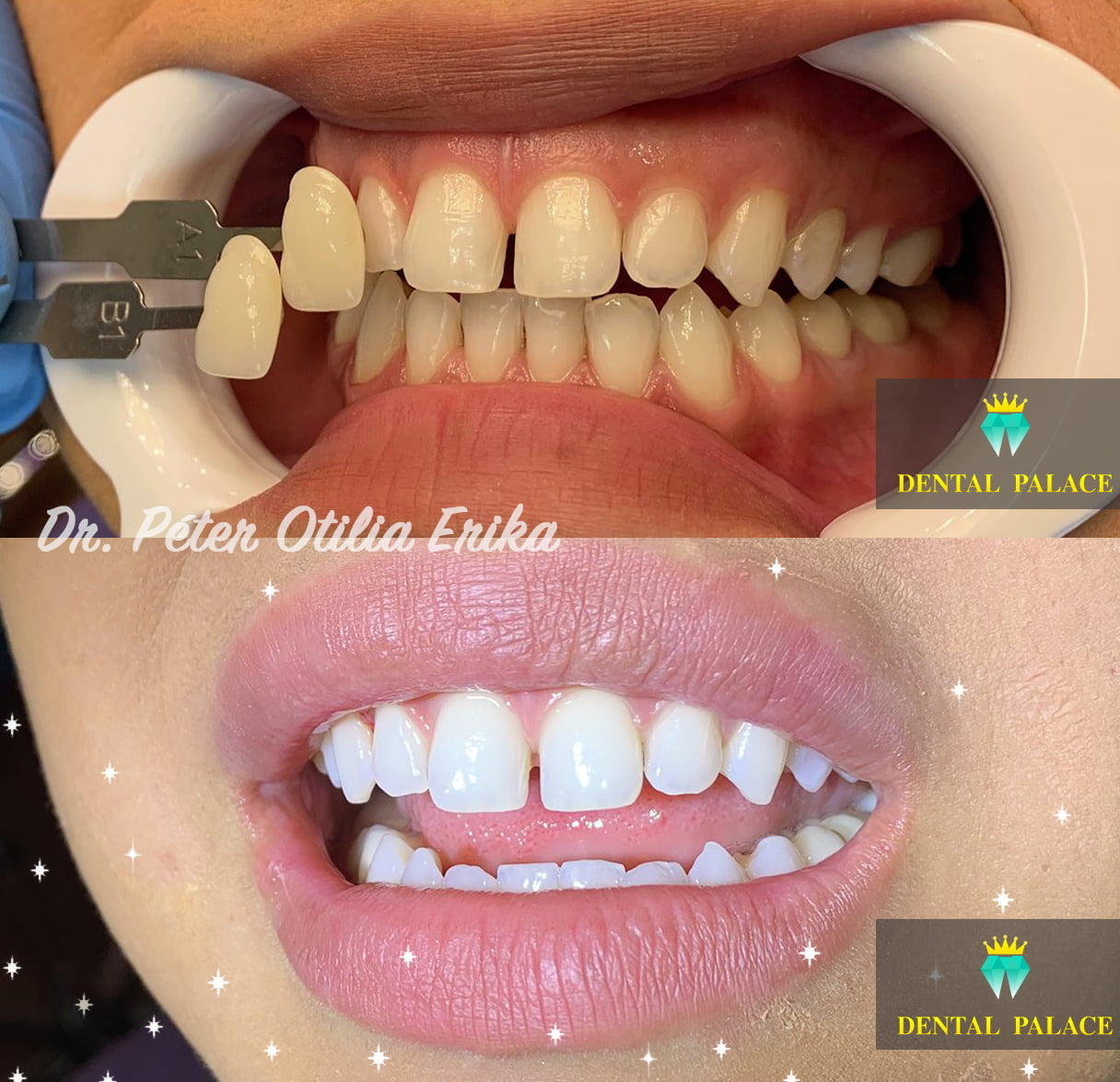 Albire cu laser – Dental Palace®